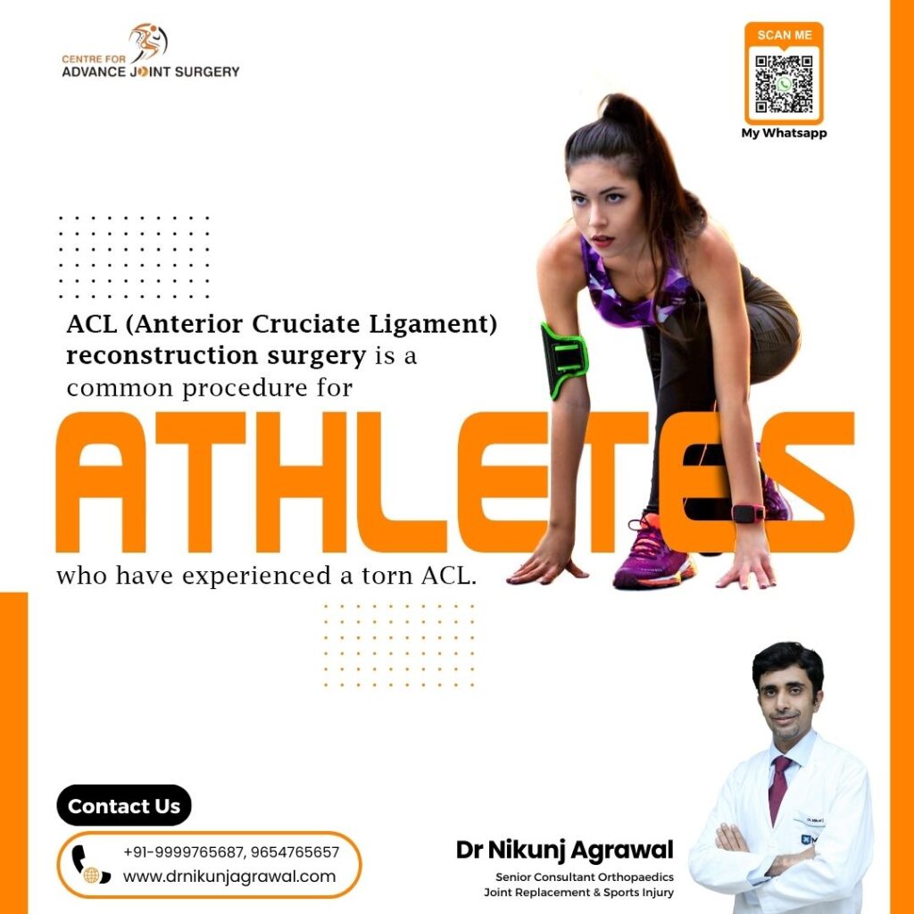 ACL (Anterior Cruciate Ligament) reconstruction surgery - Dr Nikunj Agrawal